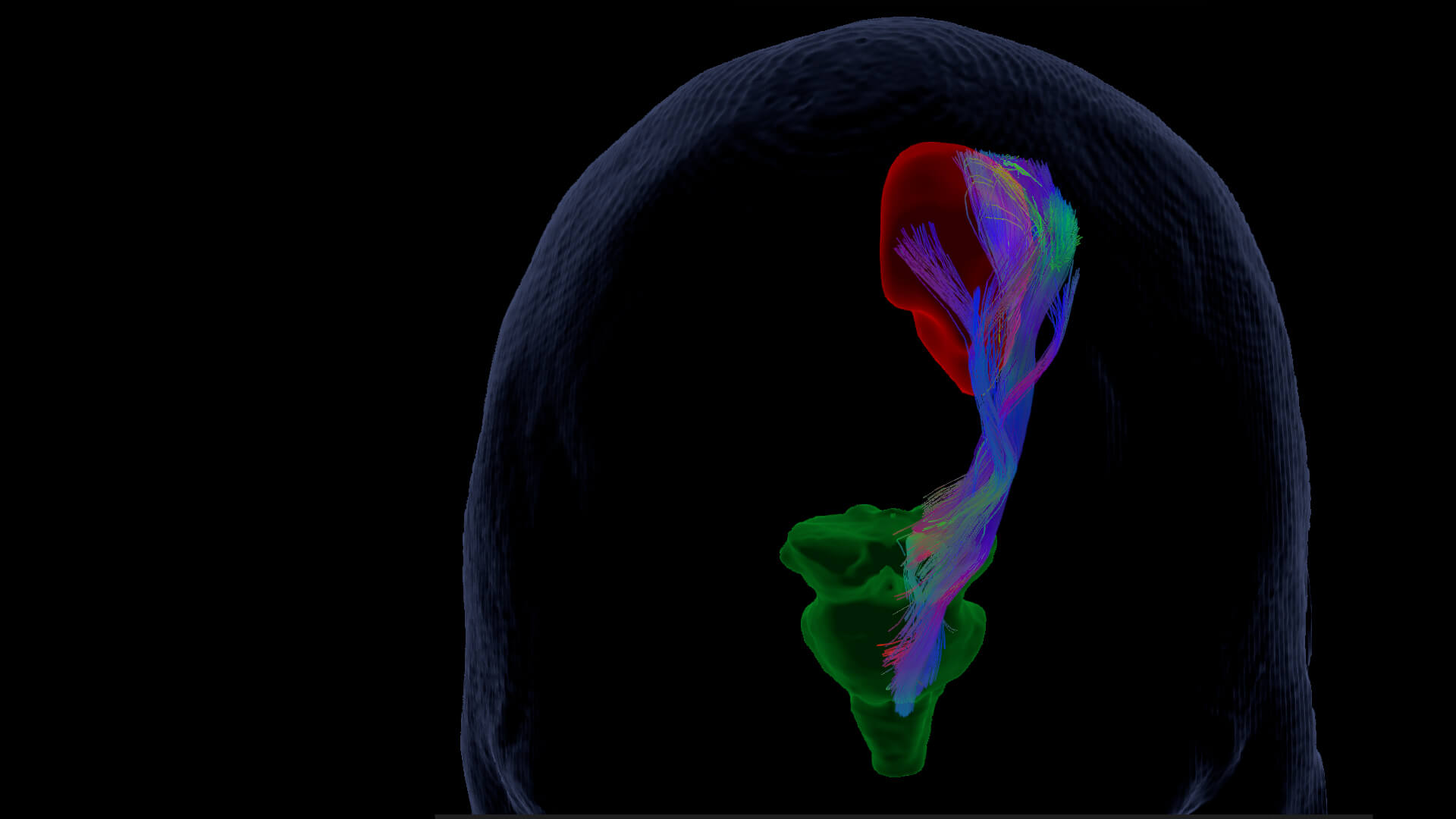Cranial Planning with Elements: Software for Neurosurgery | Brainlab